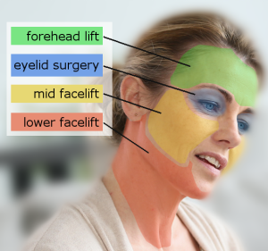 Types of Facelifts - Dr Alex Chambers | Medical Aesthetic Practice